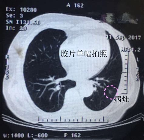 肺部ct的正常胶片图正常肺对比肺癌ct图片 伤感说说吧