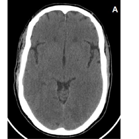 Computed Tomography Scan Questionable Right Occipitotemporal