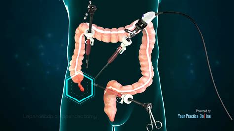 Laparoscopic Appendectomy Video Medical Video Library