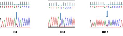 Partial DNA Sequences Of Exon 3 Of DUSP6 Gene From The Affected Female Download Scientific