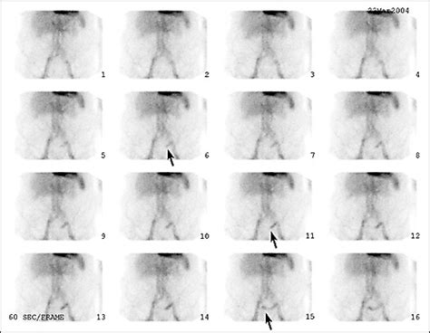 Diagnosis Of Gastrointestinal Bleeding In Adults Aafp