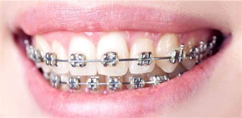 Braces And Aligners Orange Dental Clinic