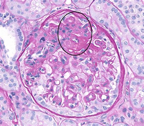 Glomerular Sclerosis