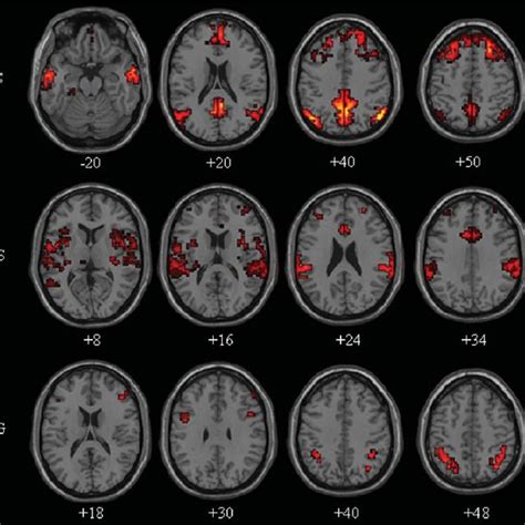 Within Group Maps Of The Respective Agsgips Functional Connectivity Download Scientific