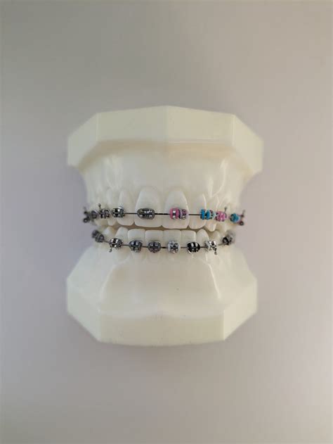 Braces Diy Kit At Esperanza Bruns Blog