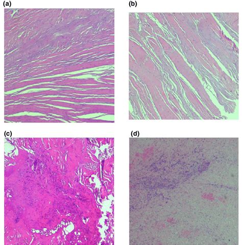 Histological Sections From Healthy And Damaged Biceps Tendon Tissue