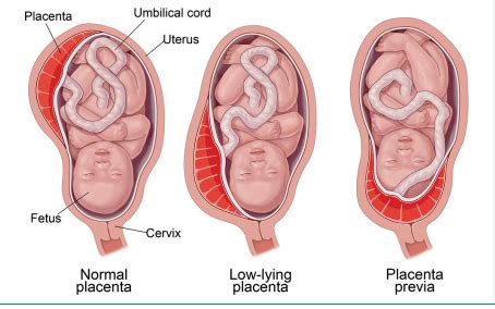 Low Lying Placenta Placenta Praevia And Placenta Accreta After 32
