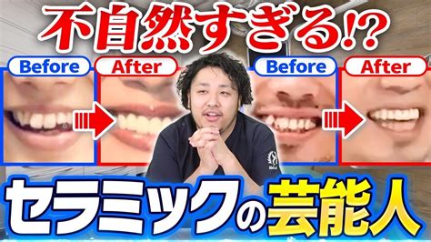 【セラミック】芸能人の矯正治療を歯医者さんが勝手に解説 Youtube