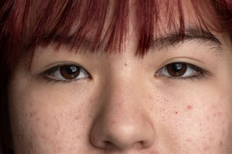 Causes Of Hyperpigmentation Under The Eyes Venus Skin Clinic