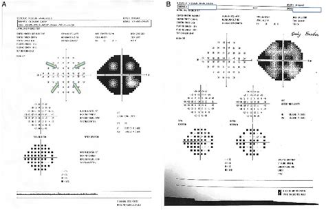 How To Interpret Visual Fields Practical Neurology