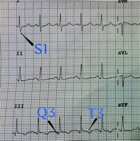Pulmonary Disease Pattern On Ekg Np