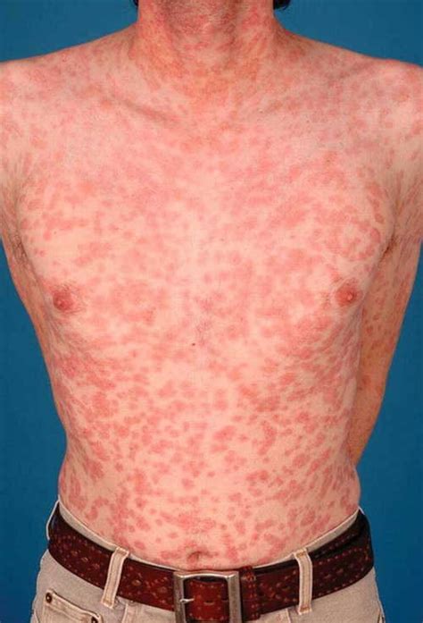 Syphilis Symptoms And Symptoms Zevflf