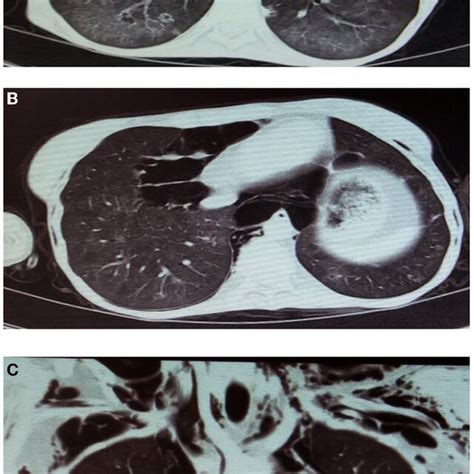 Chest X Ray Showing Bilateral Increased Interstitial Markings Figure