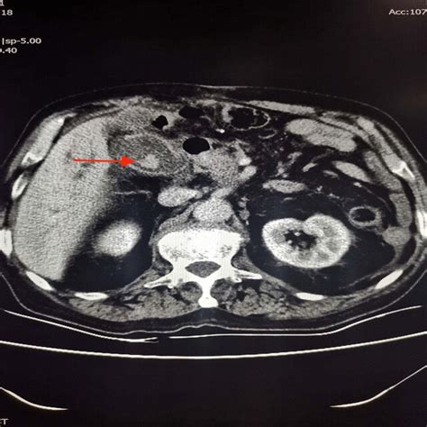 Abdominal Ct Enlarged Gallbladder Thickened Wall And Circular