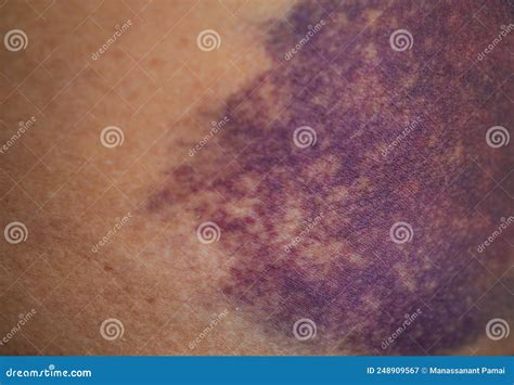 Bruise On The Buttock Skin Injury From Accident At Home Stock Image