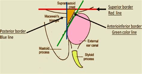 Ear Surgery Questions Dr Juvekar Explains Macewens Triangle