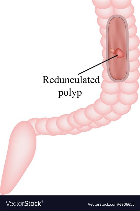 Polyp In The Intestine In The Colon Royalty Free Vector