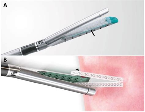 Staple Line Reinforcement for Intracorporeal Anastomosis Reduces Time for Reconstruction During ...