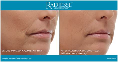 Radiesse Marionette Lines Before After Radiesse Marionette Lines Before After