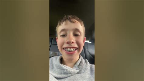 I Got Braces Youtube