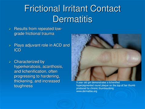 Ppt Contact Dermatitis Part One Powerpoint Presentation Free Download Id335844