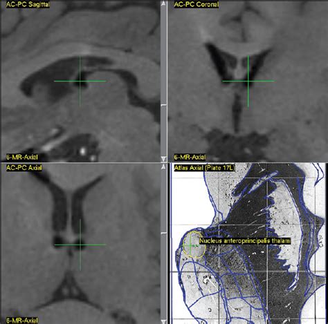 Bilateral Stereotactic Lesions And Chronic Stimulation Of The Anterior Thalamic Nuclei For