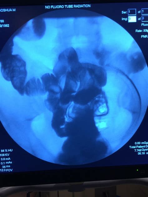 Toxic Megacolon R Nsfl