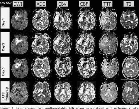 Figure 1 From Imaging The Ischemic Penumbra Semantic Scholar
