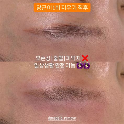 춘천잔흔제거 춘천눈썹문신제거 춘천속눈썹펌 춘천메이드비 ̈ Madebremove • Instagram Photos And Videos