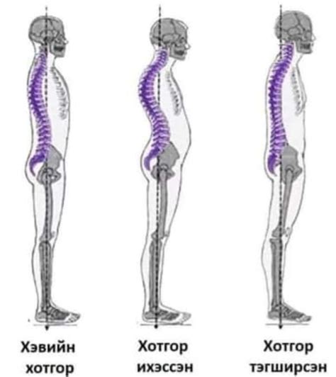 Ачит Эх Эмнэлэг Нурууны суулт мэдрэлийн гаралтай