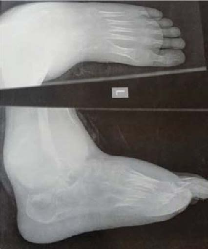 Xrayshow Lytic Lesion In The Cortical Bone Involve Distal Tibia And Download Scientific