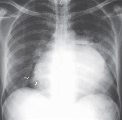 Woman With A History Of Rheumatic Fever Manual Of Medicine