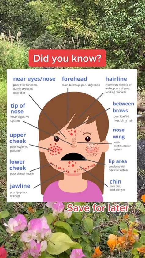 Pimple Location Tipps Für Gesunde Haut Haut Tipps Hautpflege Heilmittel