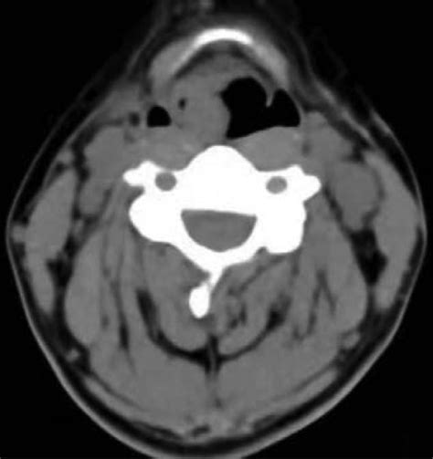 The Ct Imaging Data Of The Patient Ct Computed Tomography