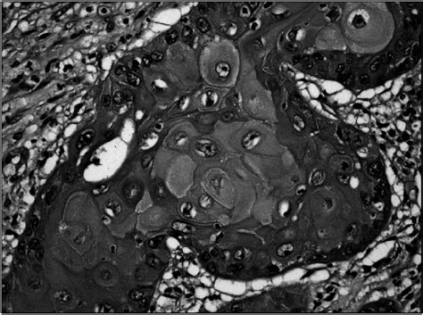Moderate Differentiated Squamous Cell Carcinoma Nests Of Infiltrating