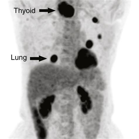 Contrast Enhanced Ct Scan Focused On The Right Thyroid Nodule That