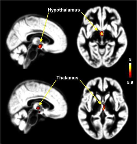 Fig Larger GM Volumes In FTMtranssexuals Comparedwith Female Controls