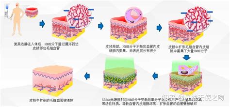 激光和光动力治疗效果差异到底有多大？这张图给你答案！ 知乎