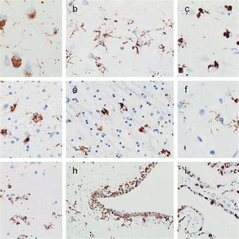 Cellular Localization Of Tmem106b C Terminal Aggregates Download