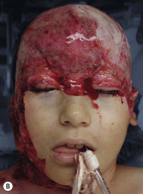【閲覧注意】遊園地の絶叫マシン、11歳の少女を恐ろしい姿に変える・・・（画像あり） ポッカキット