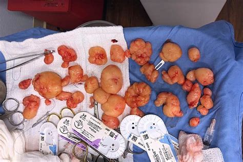 Multiple Lipomas Treatment In Hyderabad Multiple Lipomas