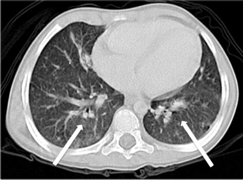 Spiculated Lung Nodule Radiology At Joseph Cornwall Blog
