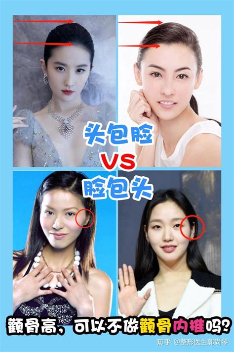 颧骨高，不好看，但是颧骨高一定要做颧骨内推吗？ 知乎