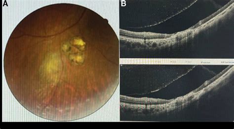 Fundus Photograph And SD OCT Image Of The Patient A Fundus Download Scientific Diagram