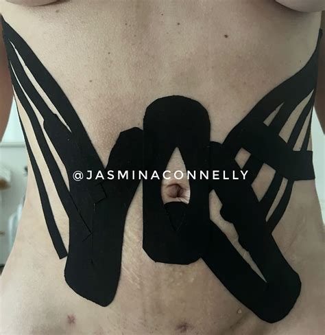 Lets Talk About Post Surgery Lymphatic Drainage And Post Op Care