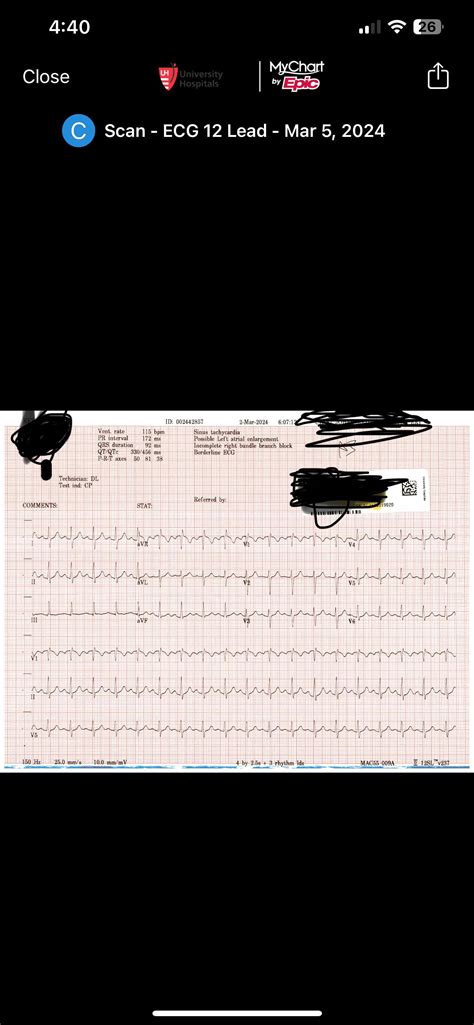 Left Atrial Enlargement Rreadmyecgs
