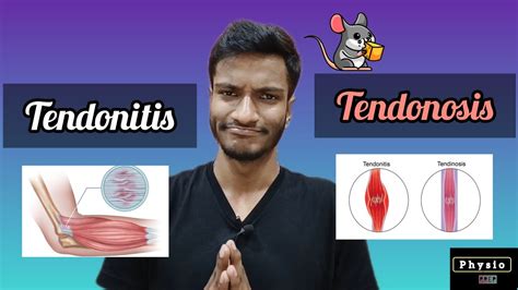 Tendonitis Vs Tendonosis Difference Causes And Treatment Medical Physiotherapy Youtube