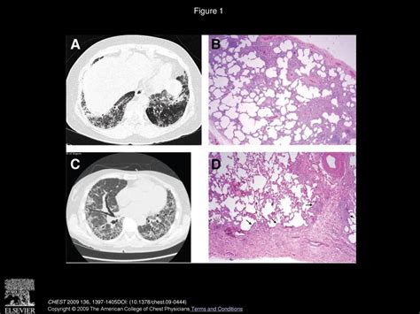 Rheumatoid Arthritis Associated Interstitial Lung Disease Ppt Download