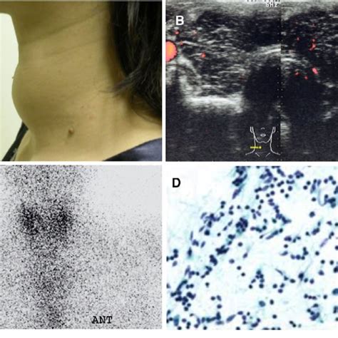 Thyroid Gland Of Case 1 A Lateral View Of The Neck Illustrates Diffuse Download Scientific