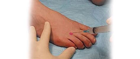 Alcohol Sclerosing Vs Alcohol Neurolytic Injections For Mortons Neuroma